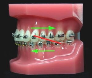 Elastics For Braces & Invisalign - Ward + Campbell Orthodontics ...