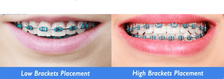Types Of Brackets And Bracket Placement - Ward + Campbell Orthodontics ...